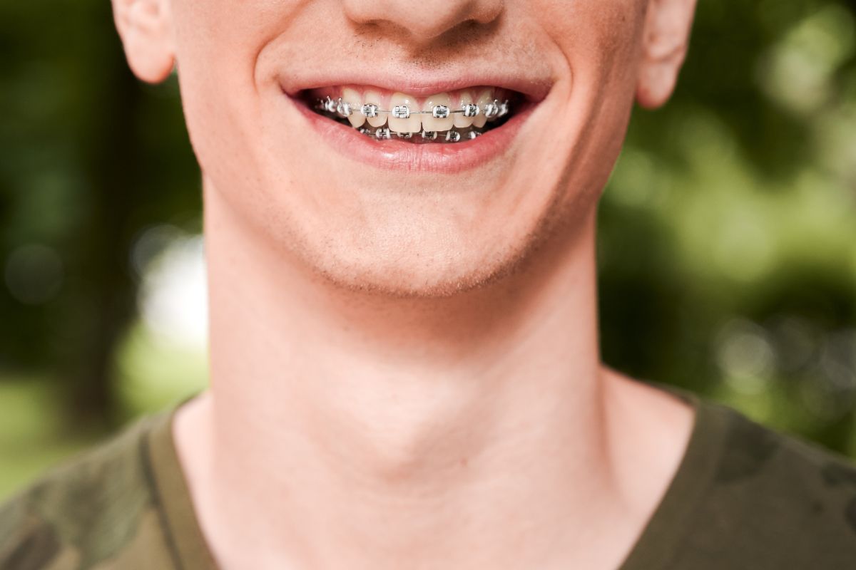 Can Braces Fix an Asymmetrical Face?