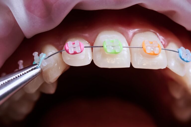 Can Braces Fix an Asymmetrical Face?